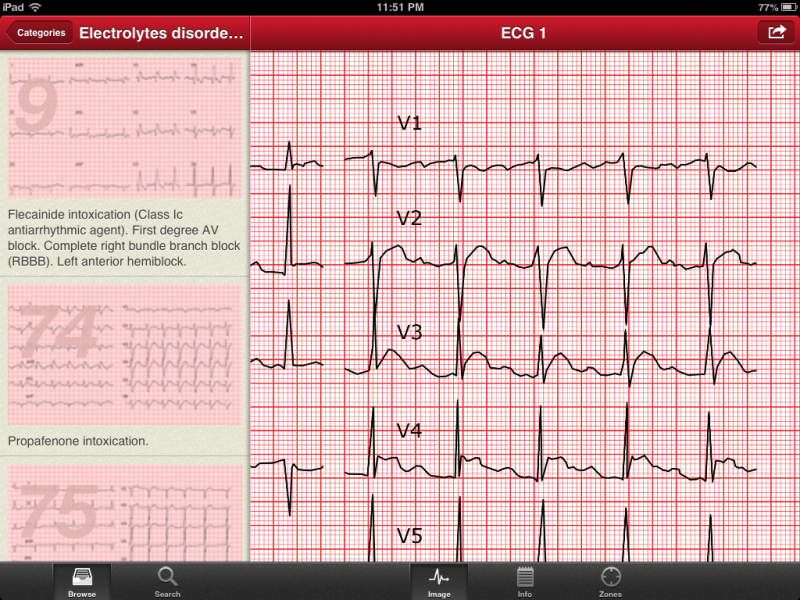 The ECG Collection iPad App Review: Electrocardiogram Resource